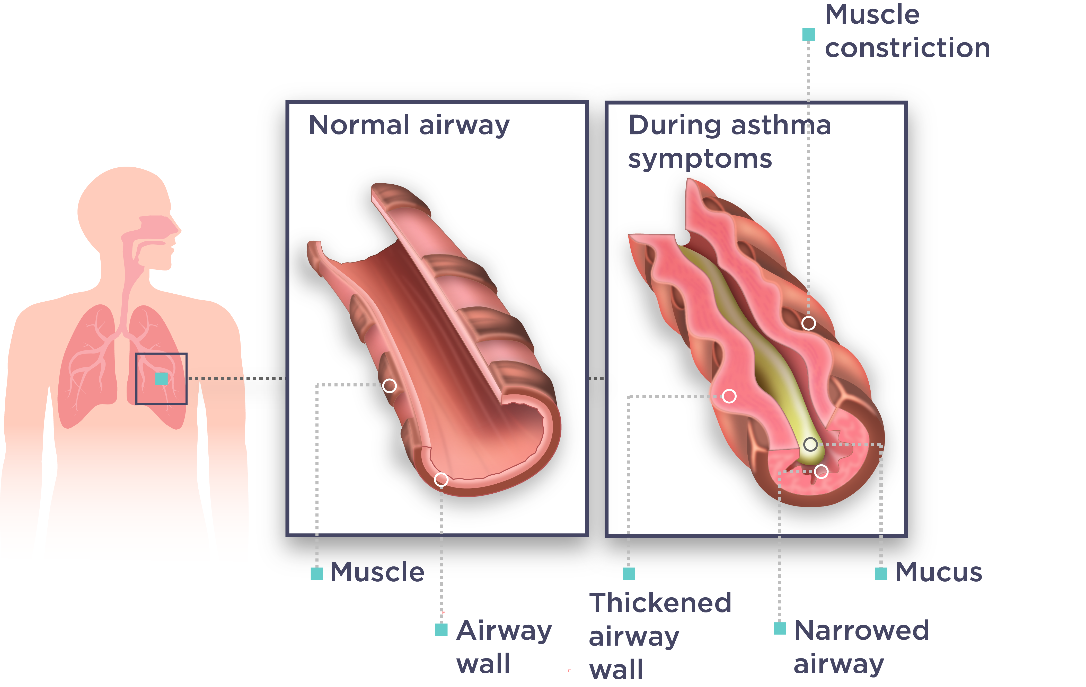 What Are The Asthma Symptoms And How Do I Know If I Have Asthma 